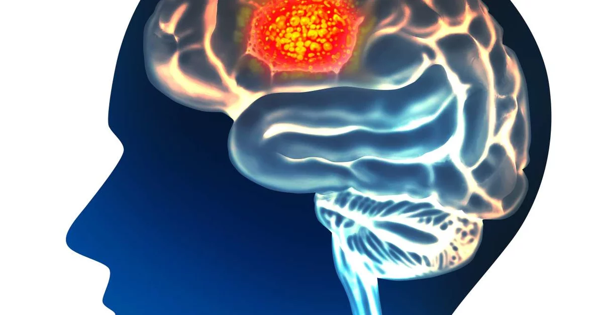 UCLA researchers identify a gene as a potential target in treatment ... UCLA researchers identify a gene as a potential target in treatment ...